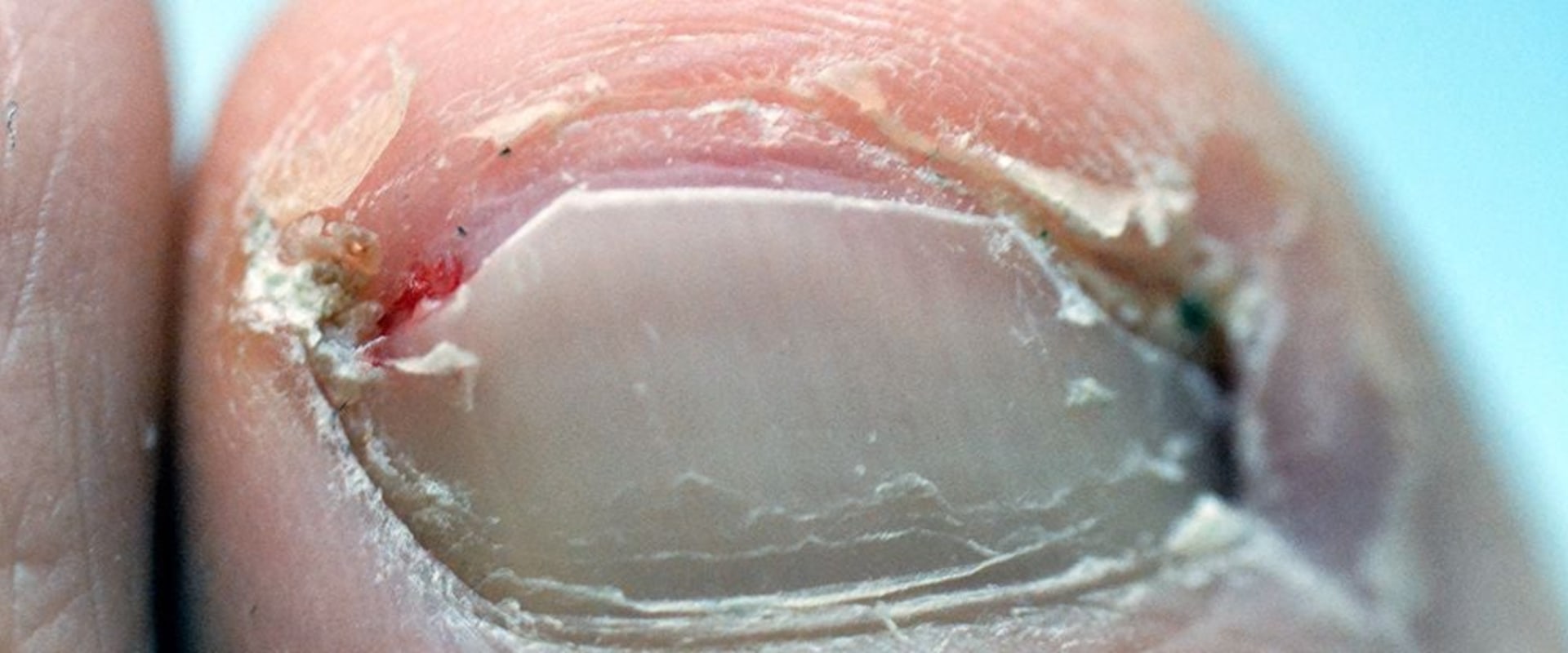 Causes of Ingrown Toenails: Understanding and Prevention