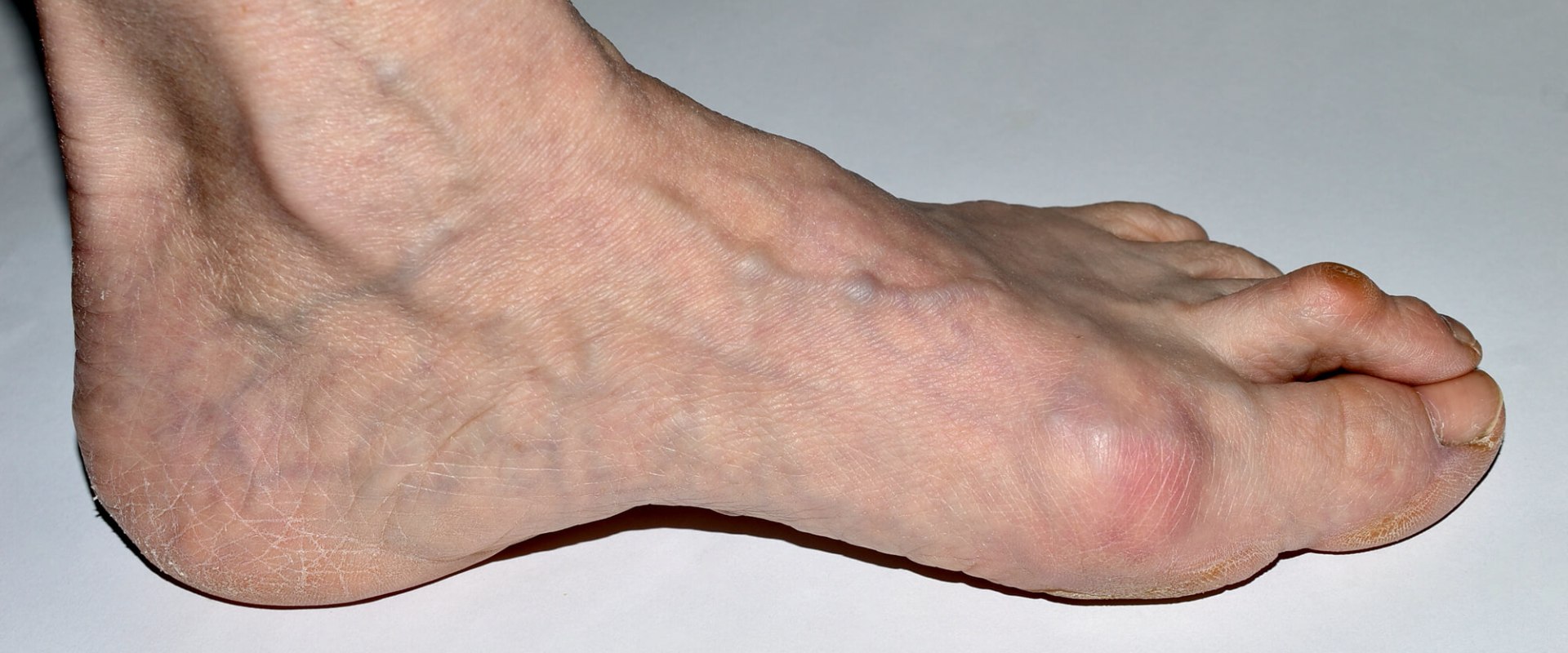 Causes of Bunions: Understanding Foot Pain and Seeking the Right ...